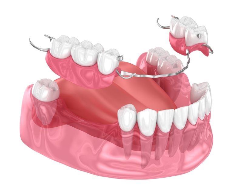 Partial Dentures - Denturist Association of Ontario